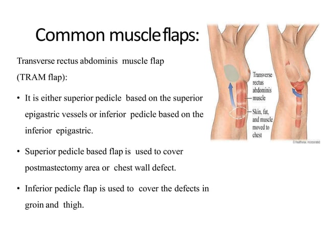 Flaps and its classification | PPTX