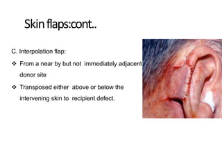 Flaps and its classification