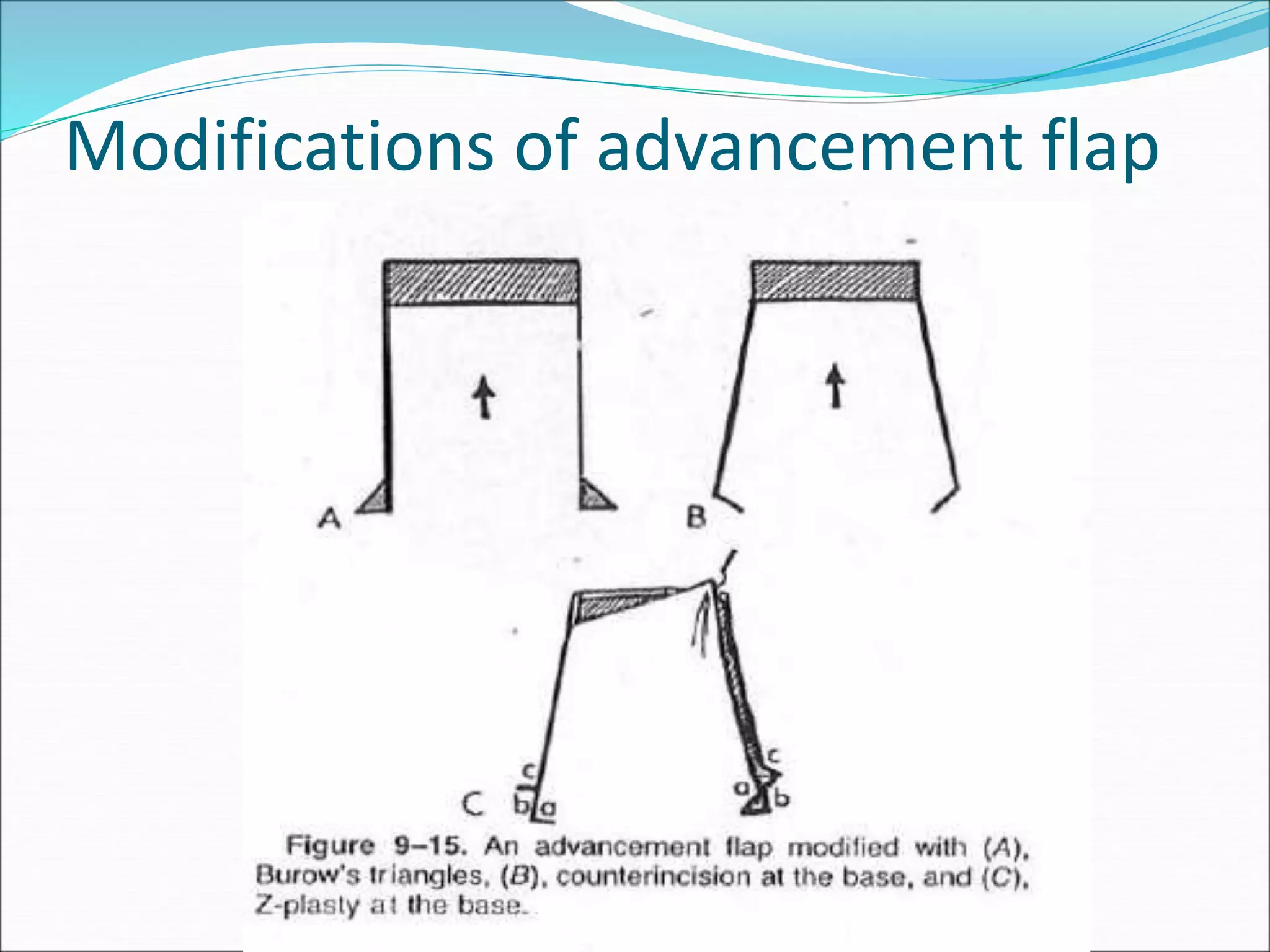 Flaps Basics and Important Leg Flaps and Trauma to Leg management | PPT