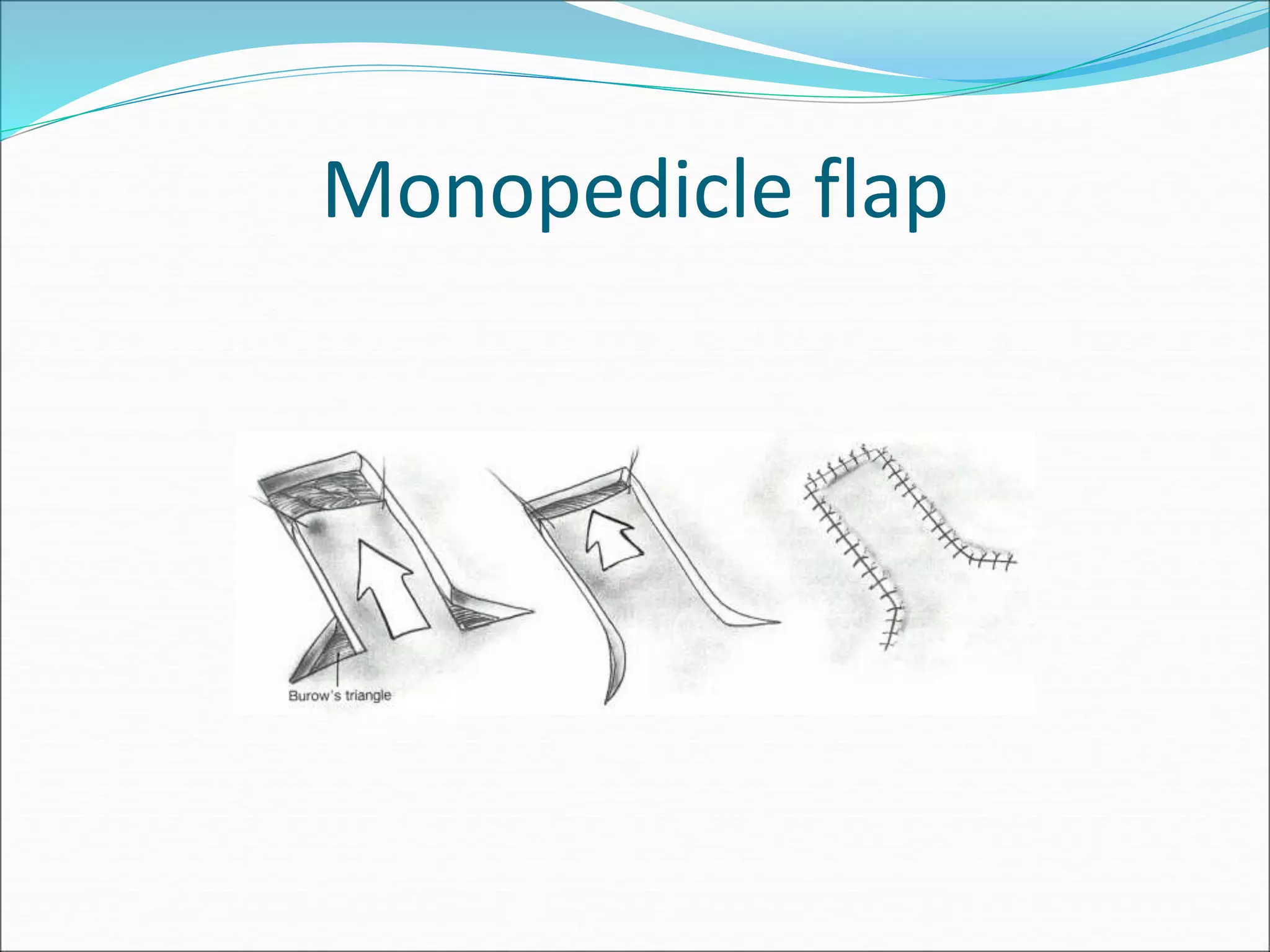 Flaps Basics and Important Leg Flaps and Trauma to Leg management | PPT
