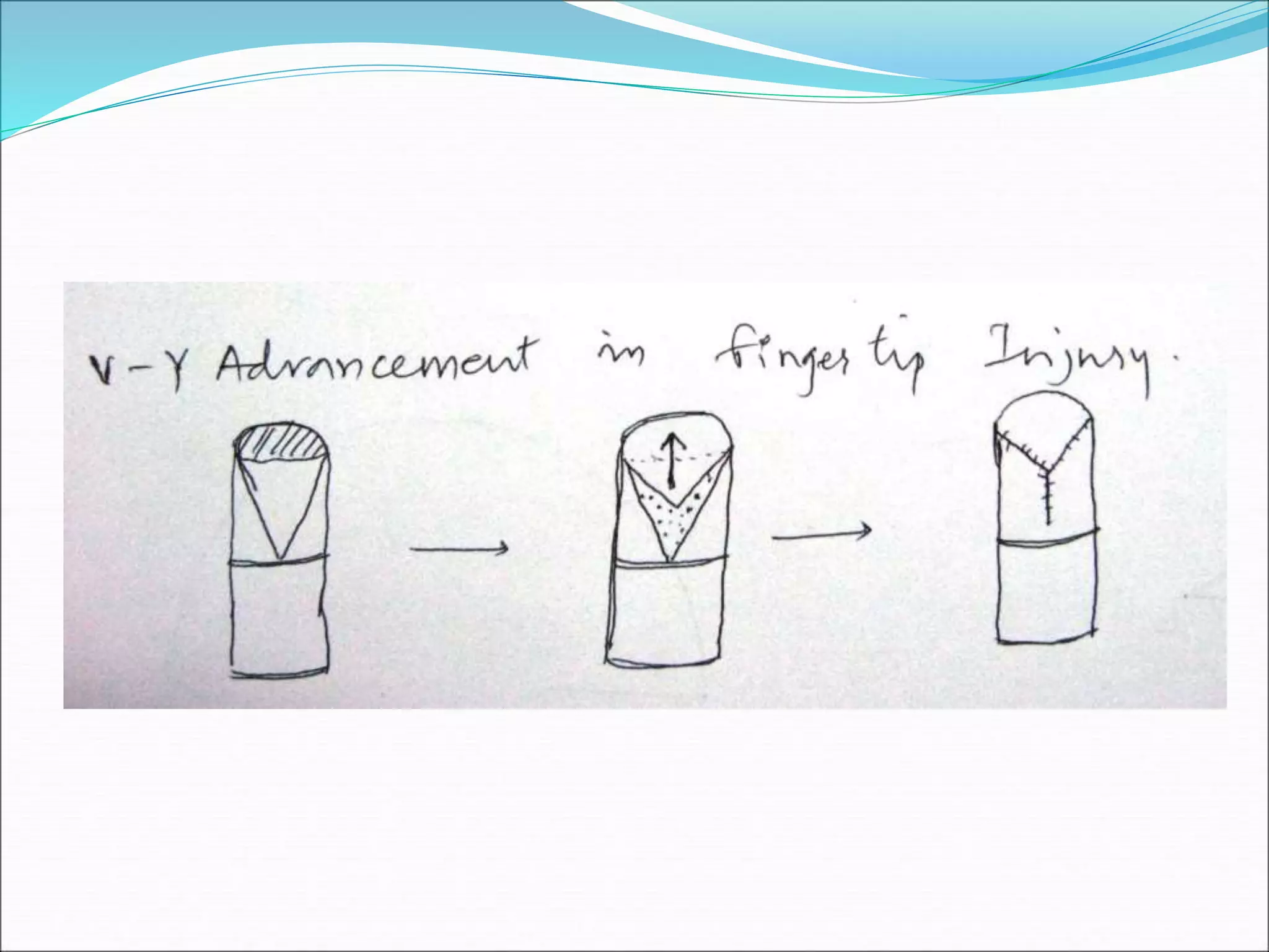 Flaps Basics and Important Leg Flaps and Trauma to Leg management | PPT