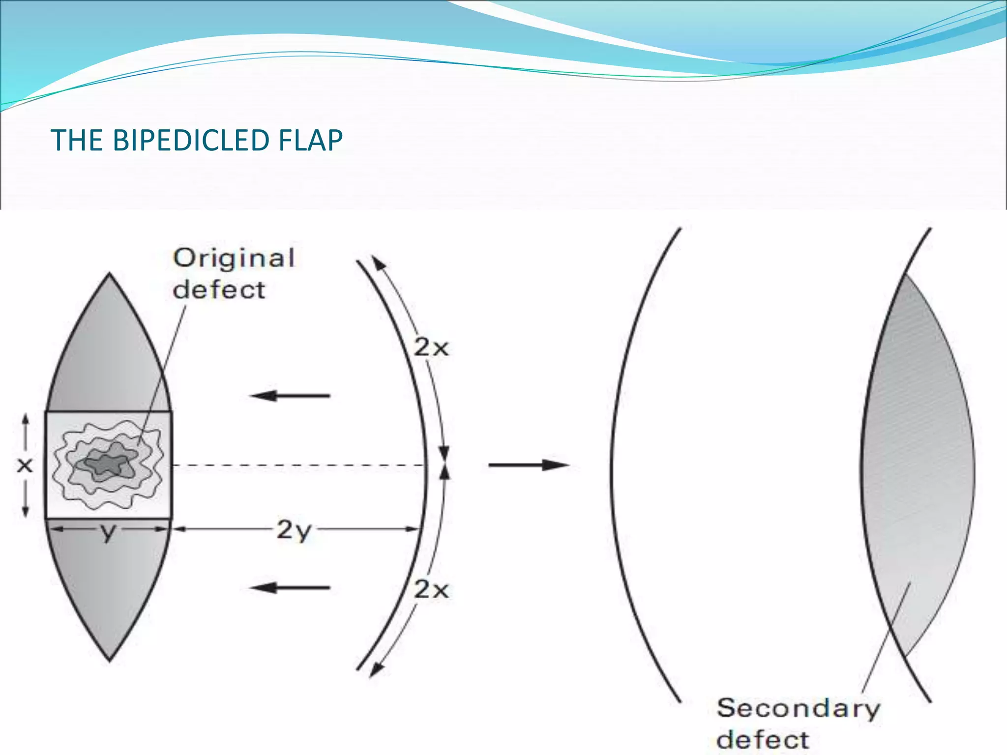 Flaps Basics and Important Leg Flaps and Trauma to Leg management | PPT