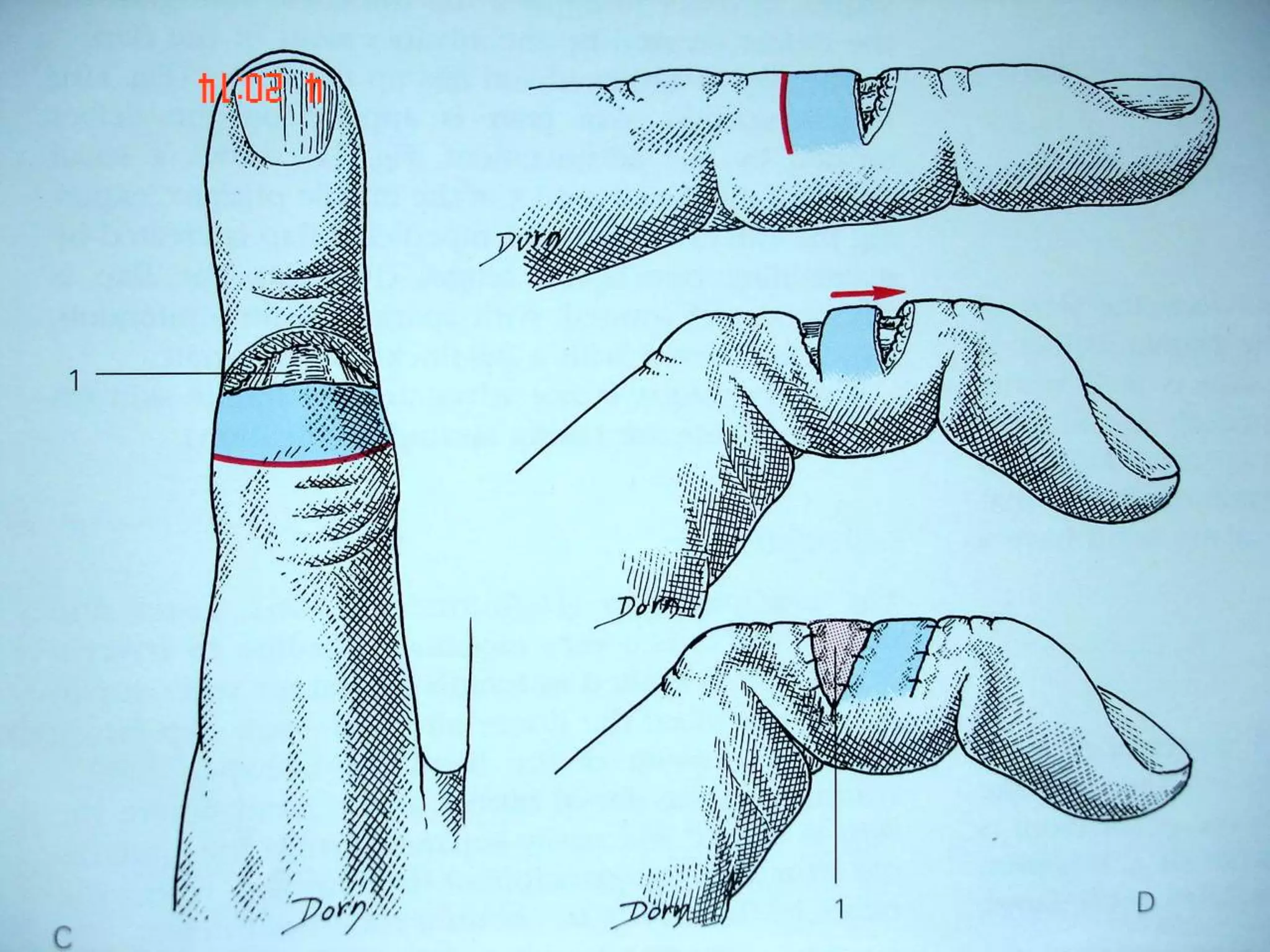 Flaps Basics and Important Leg Flaps and Trauma to Leg management | PPT