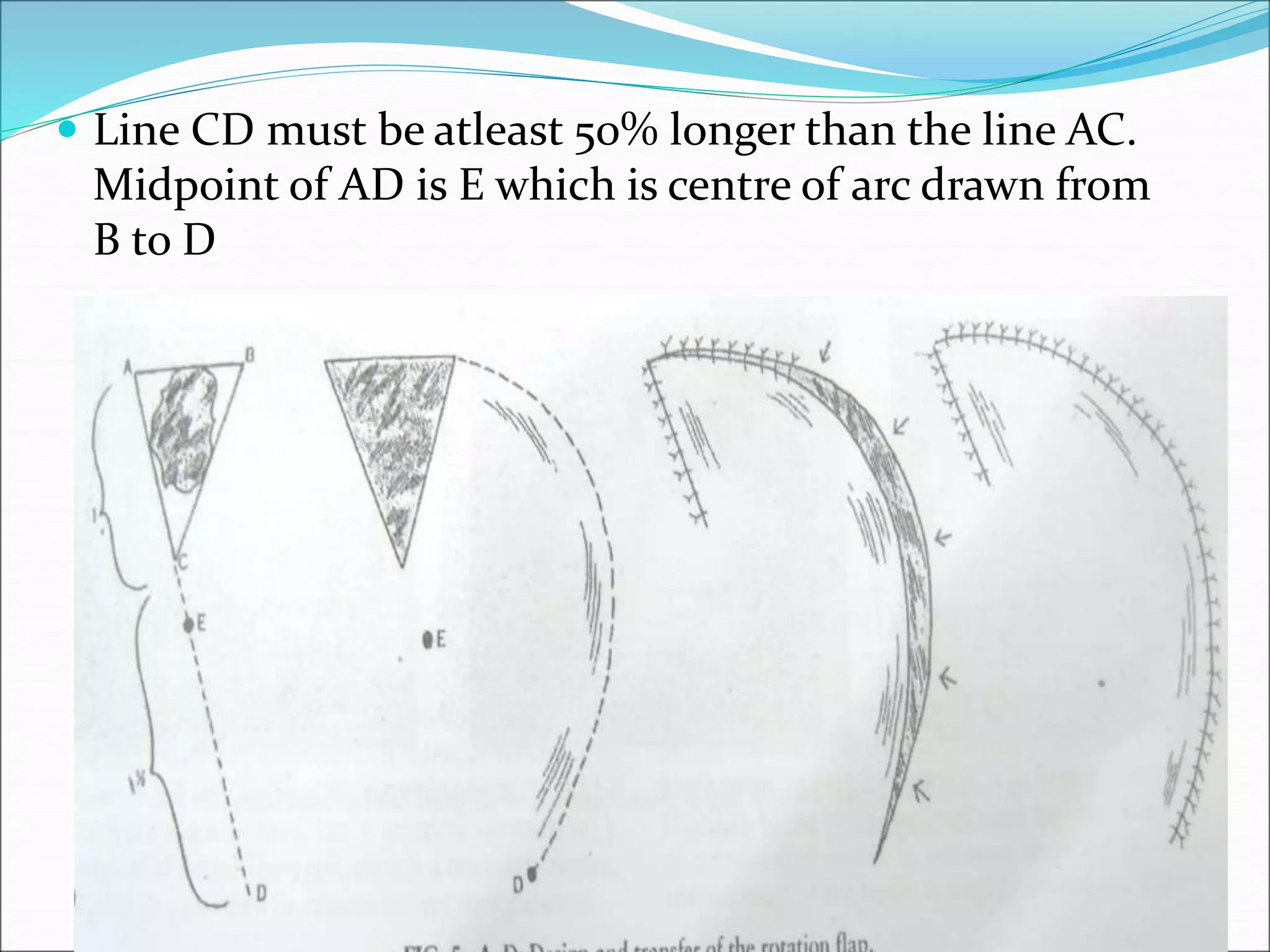 Flaps Basics and Important Leg Flaps and Trauma to Leg management | PPT