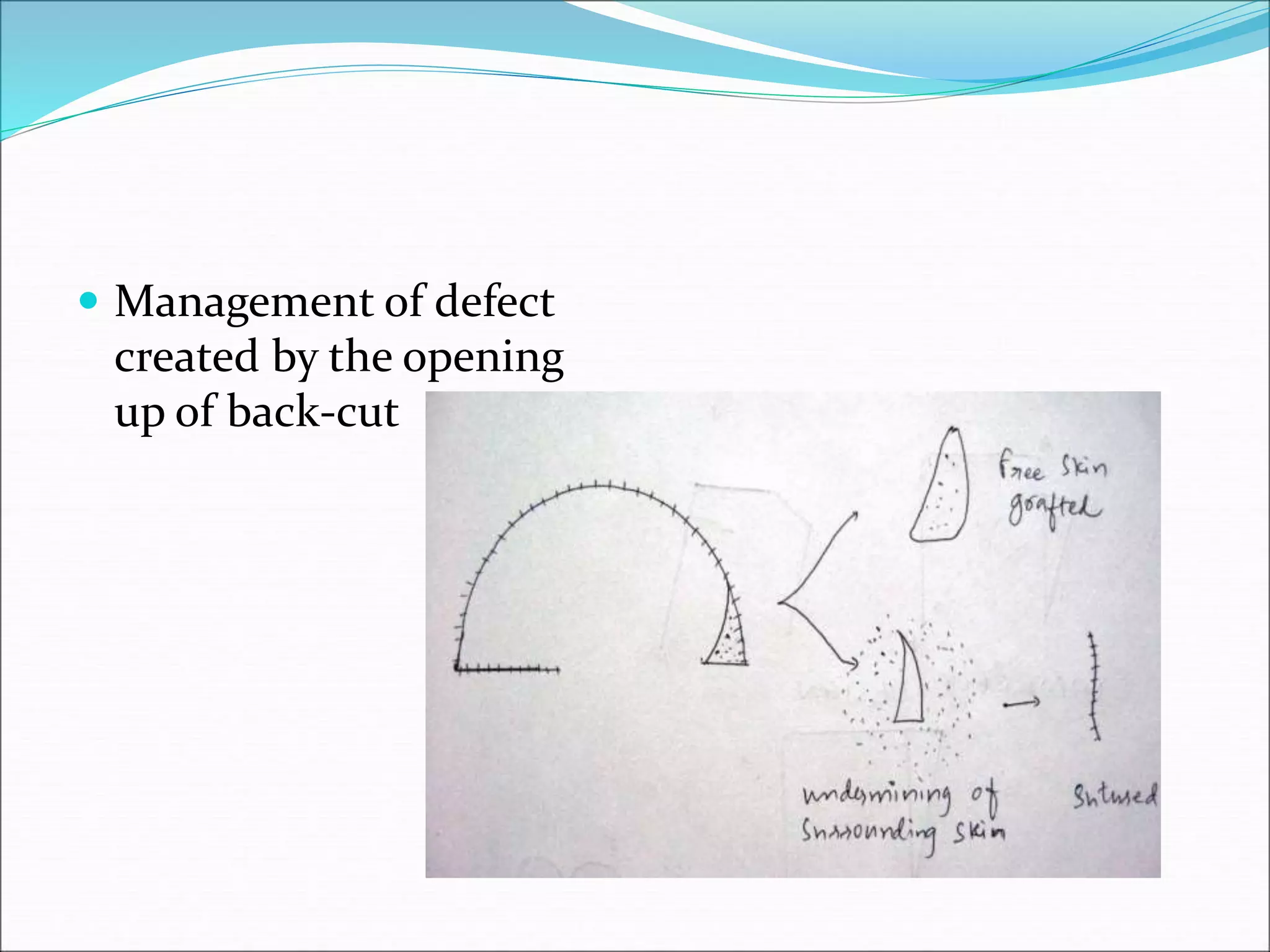 Flaps Basics and Important Leg Flaps and Trauma to Leg management | PPT