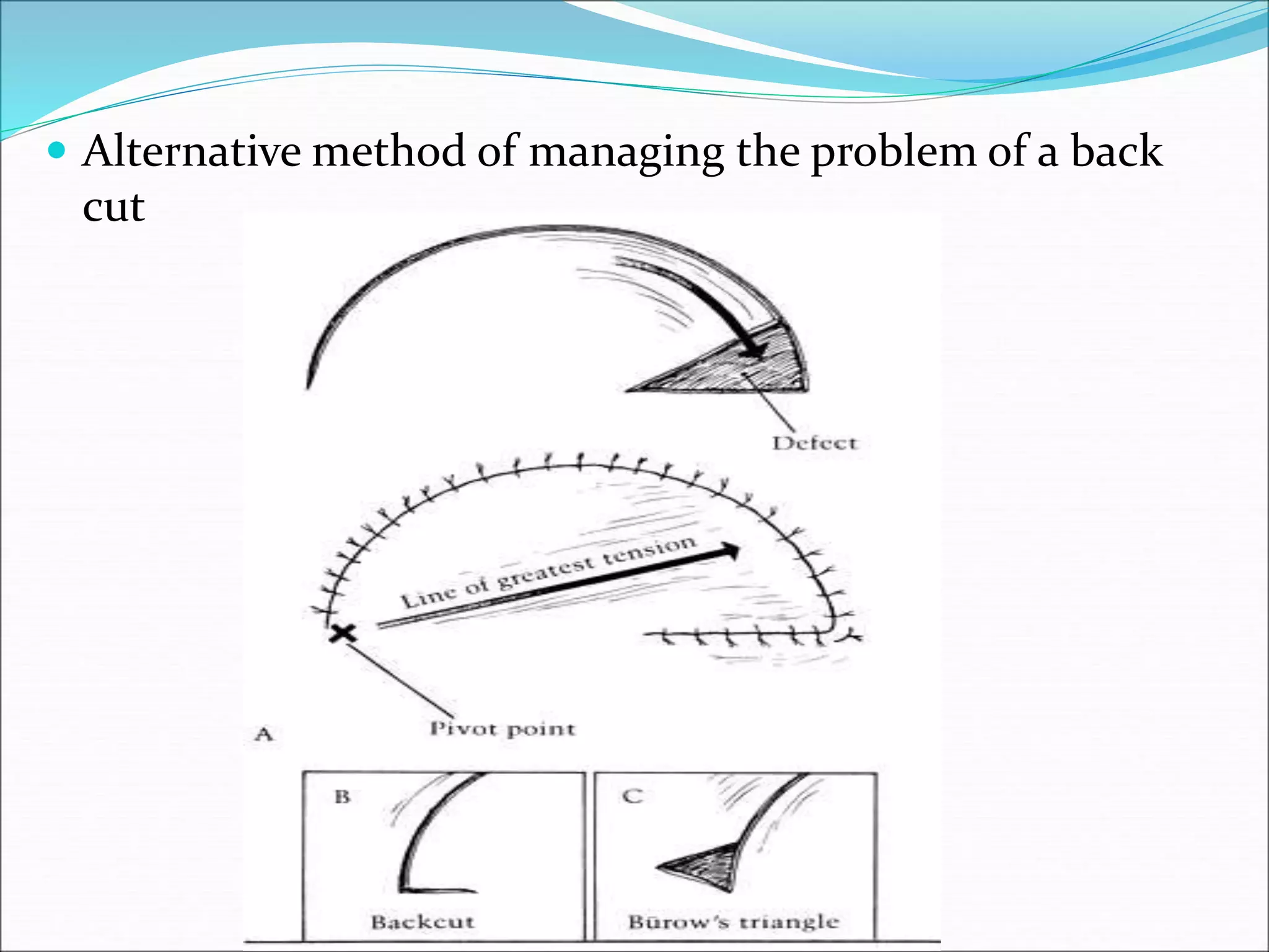 Flaps Basics and Important Leg Flaps and Trauma to Leg management | PPT