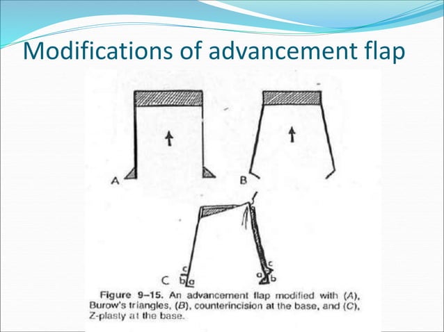 Flaps Basics and Important Leg Flaps and Trauma to Leg management | PPT