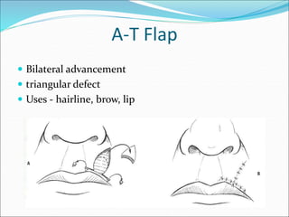 Flaps Basics and Important Leg Flaps and Trauma to Leg management | PPT