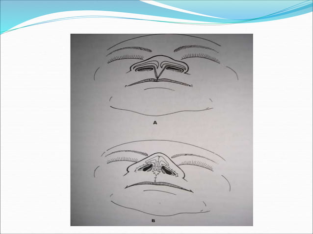 Flaps Basics and Important Leg Flaps and Trauma to Leg management | PPT