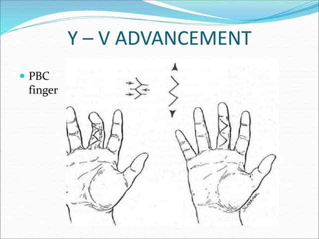 Flaps Basics and Important Leg Flaps and Trauma to Leg management | PPT