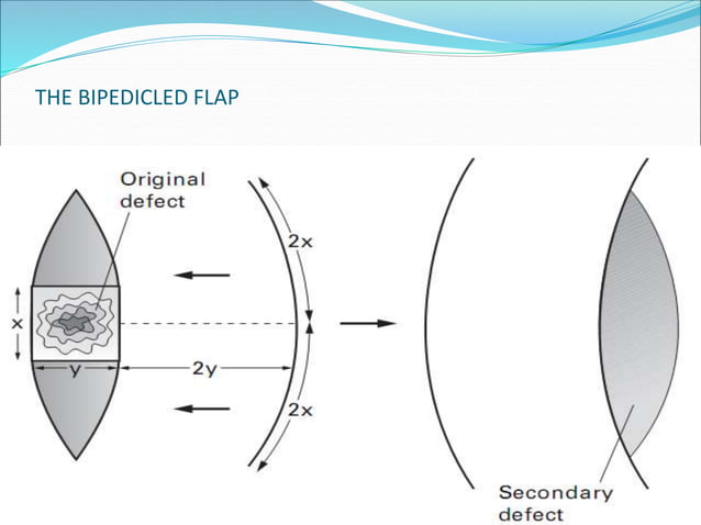 Flaps Basics and Important Leg Flaps and Trauma to Leg management | PPT
