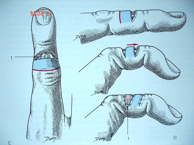 Flaps Basics and Important Leg Flaps and Trauma to Leg management | PPT