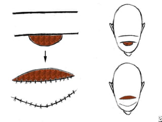 Flaps Basics and Important Leg Flaps and Trauma to Leg management | PPT