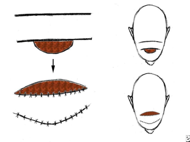 Flaps Basics and Important Leg Flaps and Trauma to Leg management | PPT