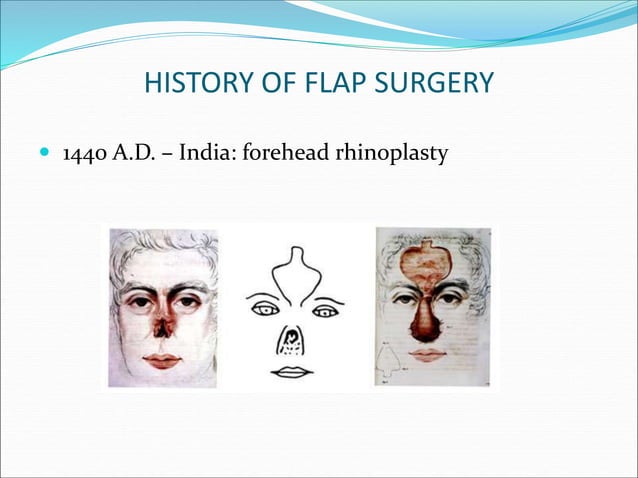 Flaps Basics and Important Leg Flaps and Trauma to Leg management | PPT