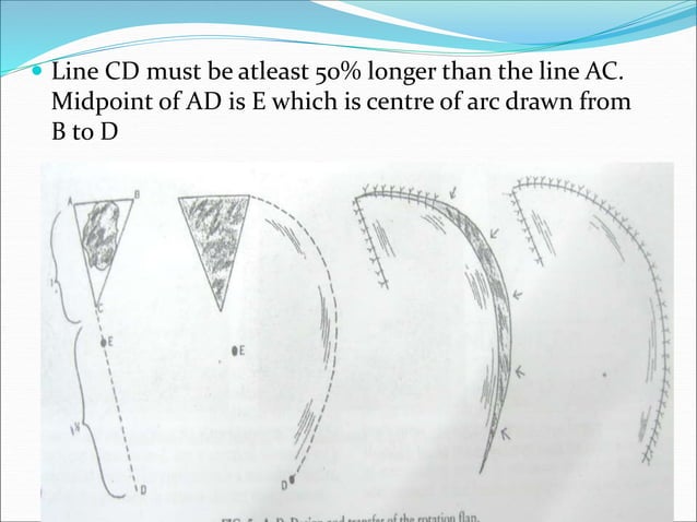 Flaps Basics and Important Leg Flaps and Trauma to Leg management | PPT