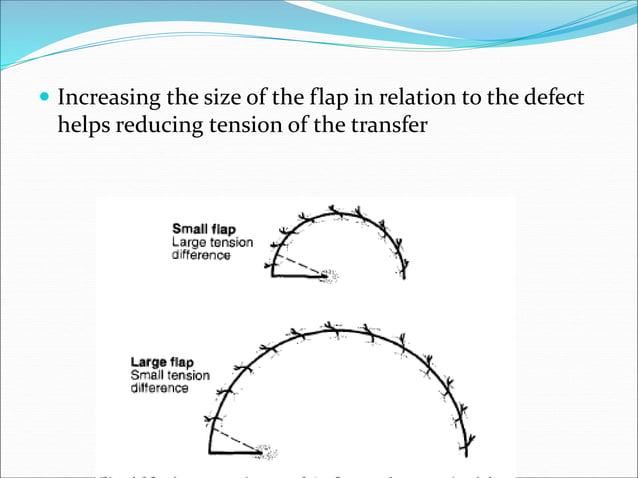 Flaps Basics and Important Leg Flaps and Trauma to Leg management | PPT