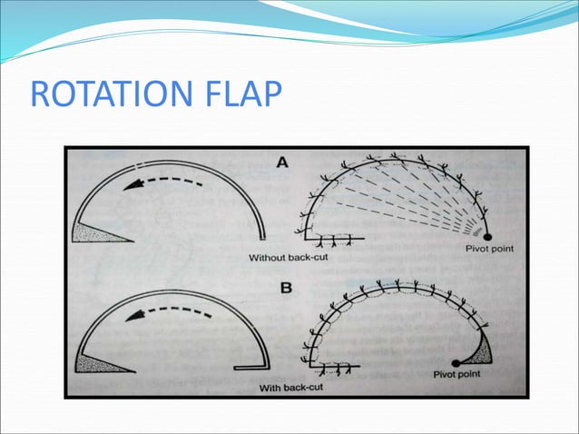 Flaps Basics and Important Leg Flaps and Trauma to Leg management | PPT