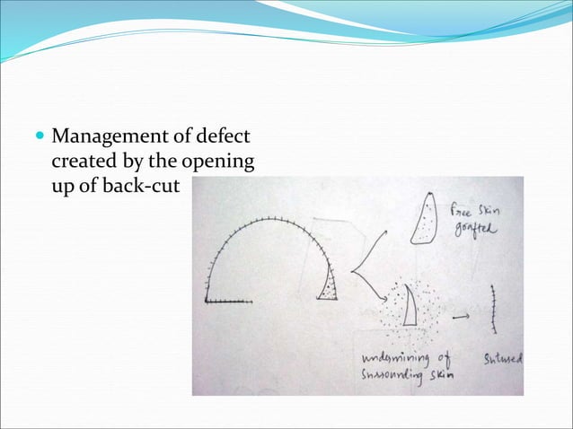 Flaps Basics and Important Leg Flaps and Trauma to Leg management | PPT