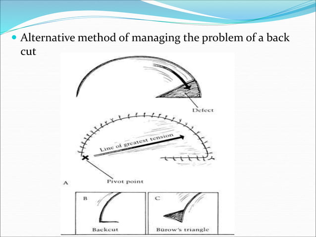 Flaps Basics and Important Leg Flaps and Trauma to Leg management | PPT
