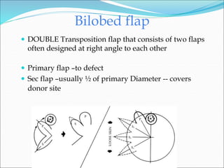 Flaps Basics and Important Leg Flaps and Trauma to Leg management | PPT