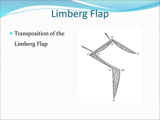Flaps Basics and Important Leg Flaps and Trauma to Leg management | PPT