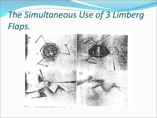 Flaps Basics and Important Leg Flaps and Trauma to Leg management | PPT