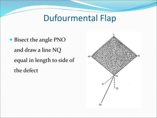 Flaps Basics and Important Leg Flaps and Trauma to Leg management | PPT