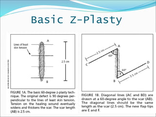 Flaps Basics and Important Leg Flaps and Trauma to Leg management | PPT