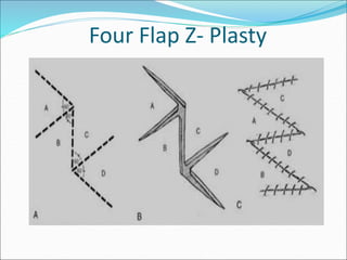 Flaps Basics and Important Leg Flaps and Trauma to Leg management | PPT