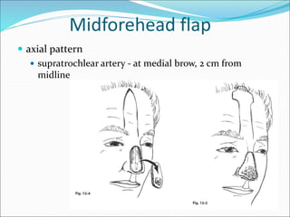Flaps Basics and Important Leg Flaps and Trauma to Leg management | PPT