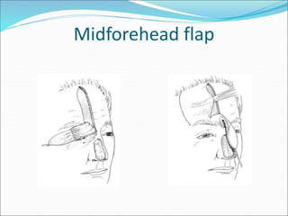 Flaps Basics and Important Leg Flaps and Trauma to Leg management | PPT