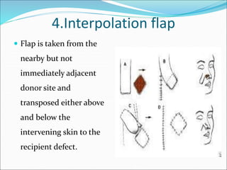 Interpolation Flap