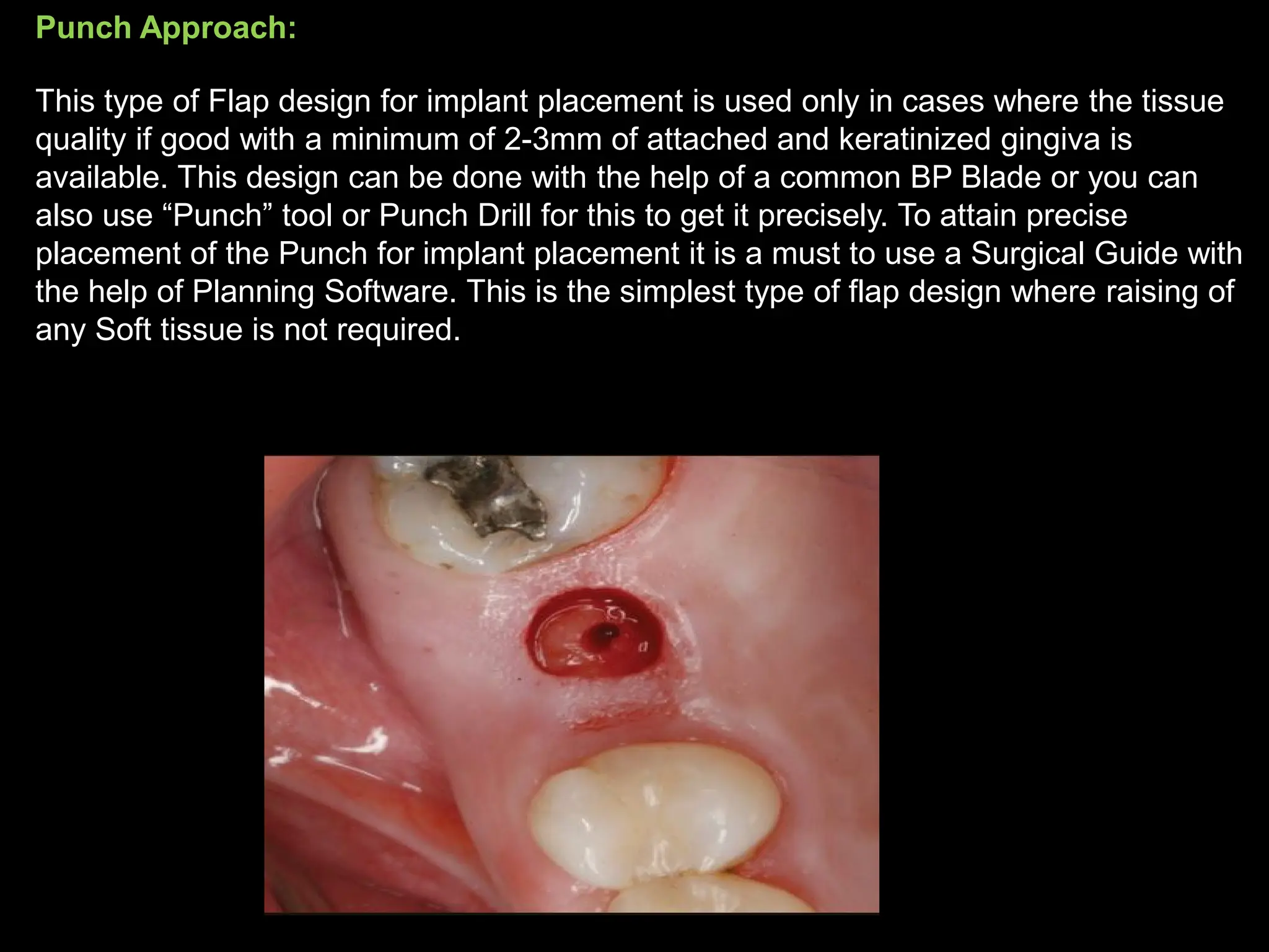The flaps for dental implants in mouth.. | PDF