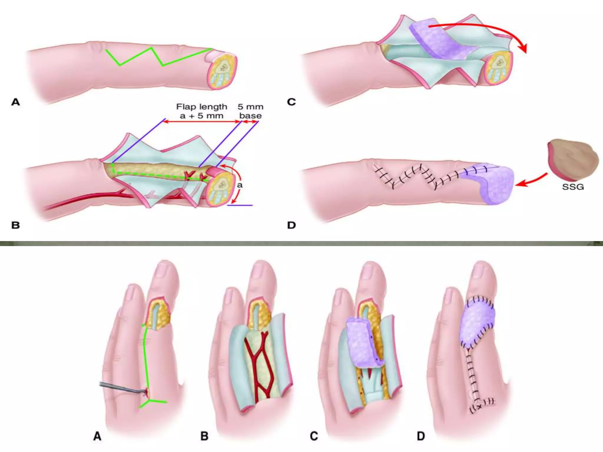 Flaps hand - harsh amin | PPT