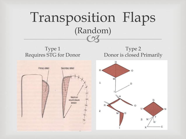 Flaps hand - harsh amin