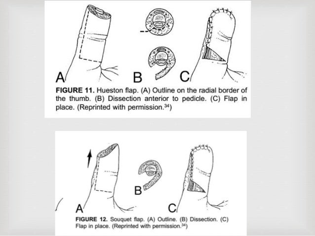 Flaps hand - harsh amin