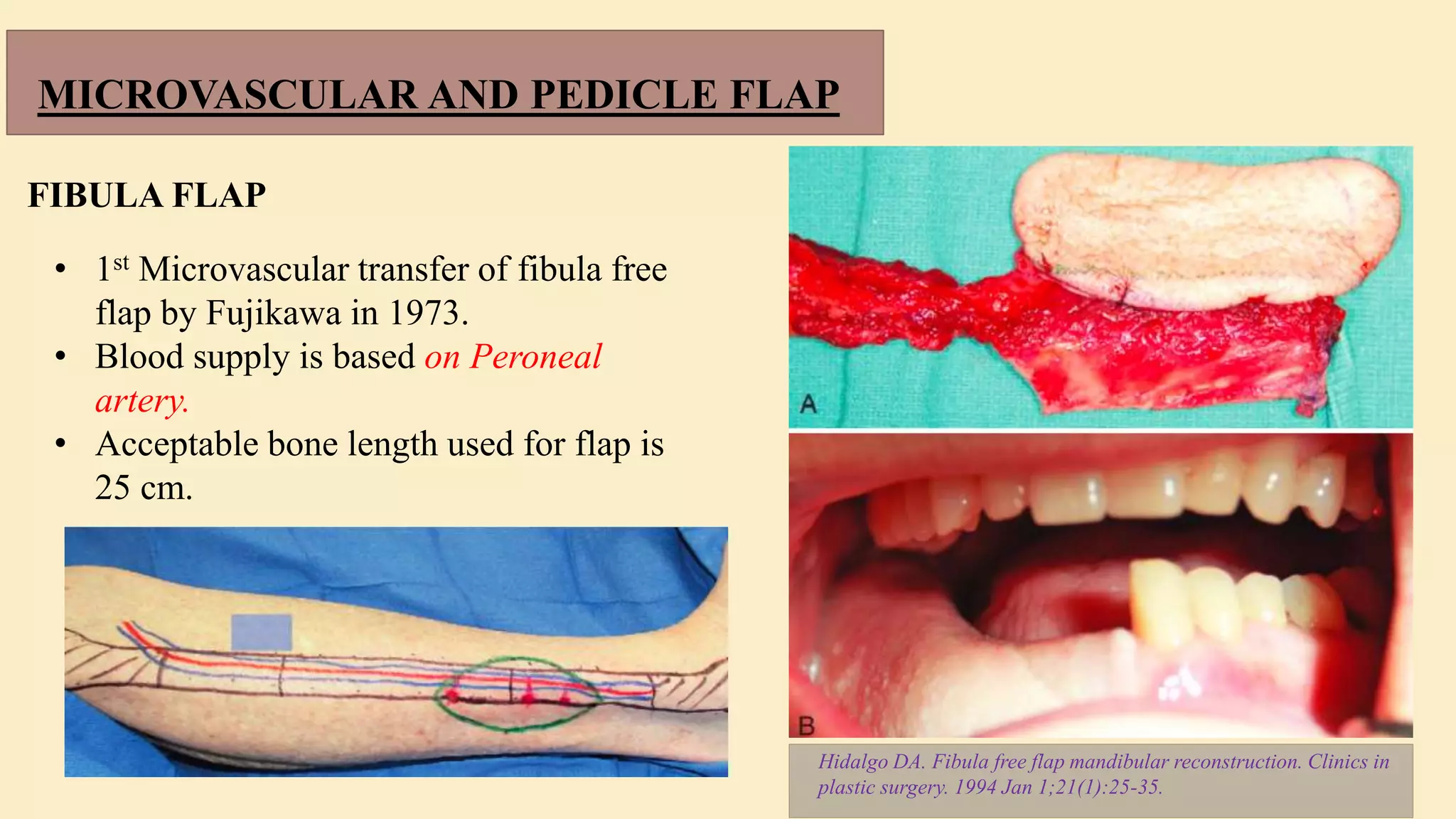FLAPS IN ORAL AND MAXILLOFACIAL SURGERY (monday ppt).pptx