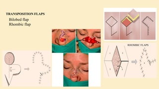 FLAPS IN ORAL AND MAXILLOFACIAL SURGERY (monday ppt).pptx