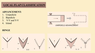 FLAPS IN ORAL AND MAXILLOFACIAL SURGERY (monday ppt).pptx