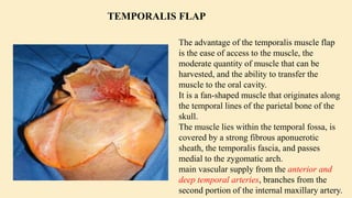 FLAPS IN ORAL AND MAXILLOFACIAL SURGERY (monday ppt).pptx
