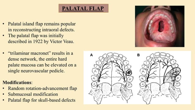 FLAPS IN ORAL AND MAXILLOFACIAL SURGERY (monday ppt).pptx