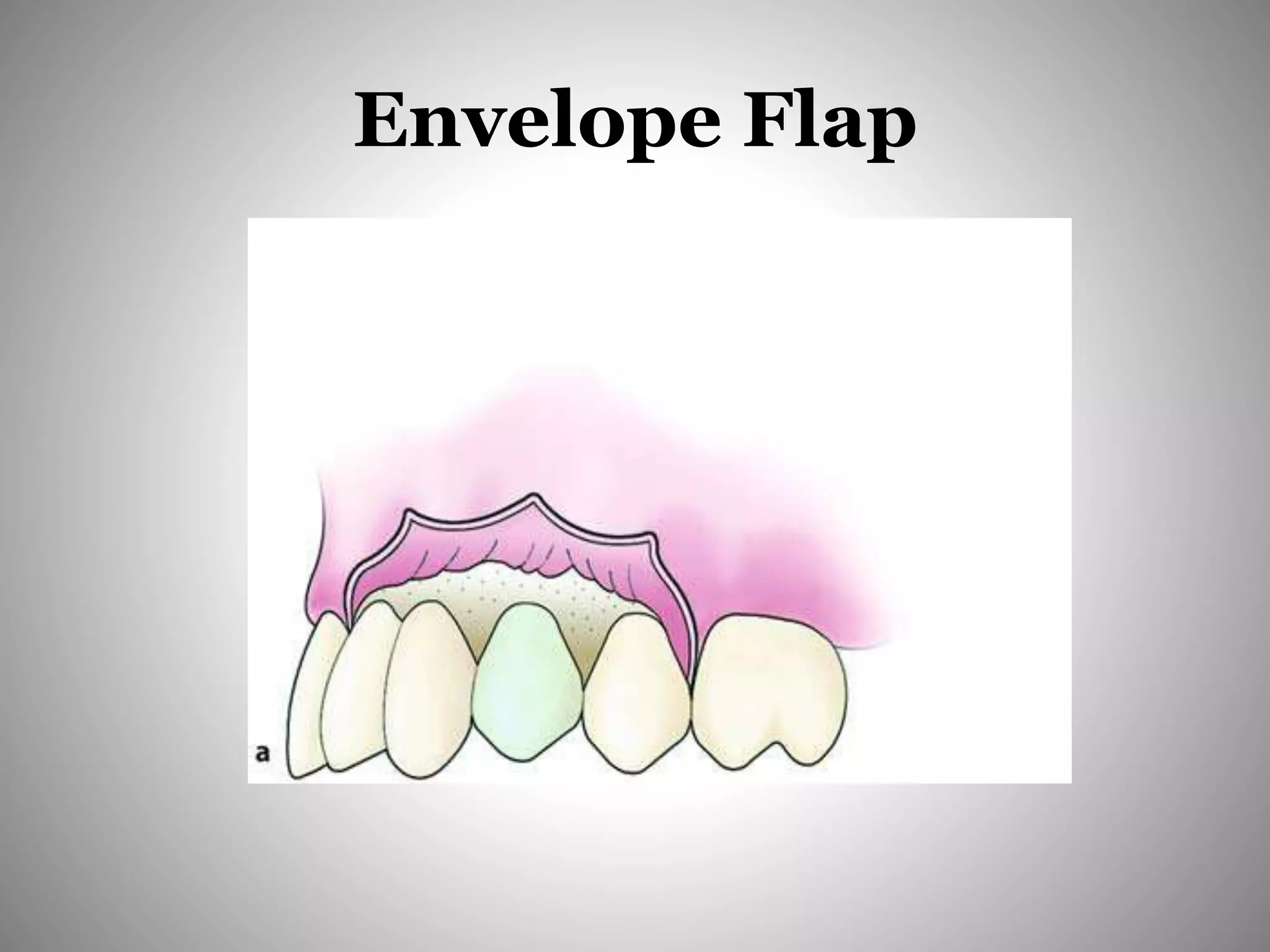 Flaps in oral surgery | PPTX