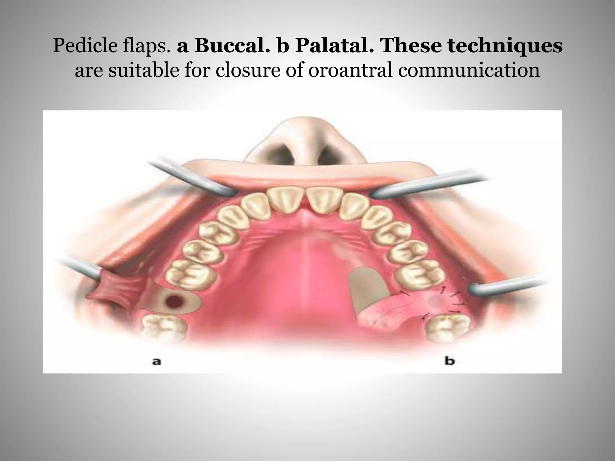 Flaps in oral surgery | PPTX | Dental Health | Diseases and Conditions