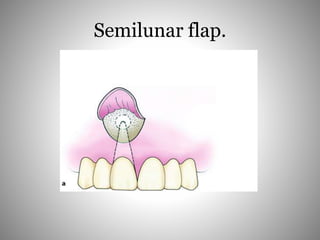 Flaps in oral surgery | PPTX | Dental Health | Diseases and Conditions