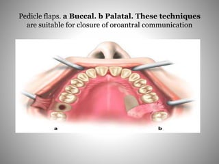 Flaps in oral surgery | PPTX
