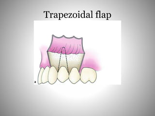 Flaps in oral surgery | PPTX | Dental Health | Diseases and Conditions