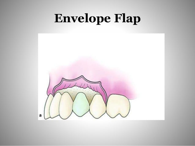 Flaps in oral surgery