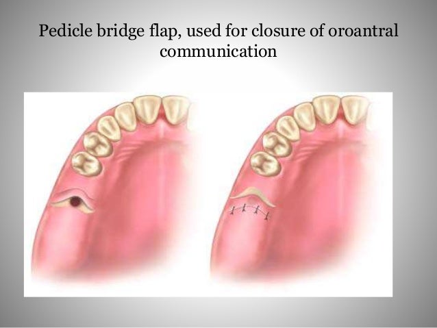 Flaps in oral surgery