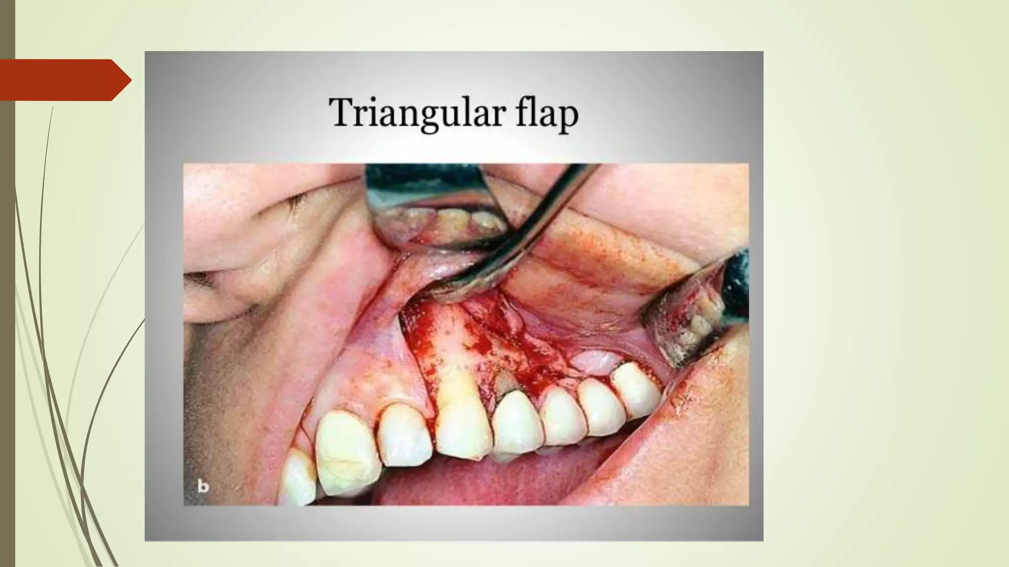 Flaps in oral surgery | PPTX